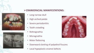 Genetic and chromosomal aberrations in children | PPTX