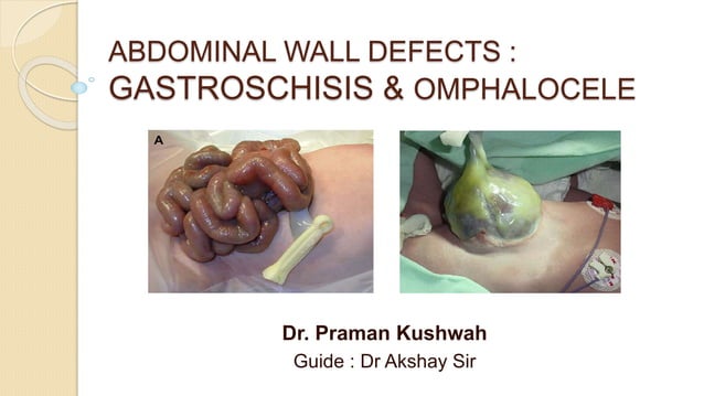 abdominal wall defect | PPTX