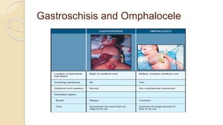 abdominal wall defect | PPTX