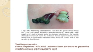 abdominal wall defect | PPTX