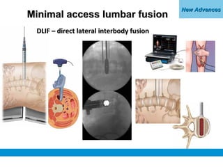 New advances in spine surgery | PPT