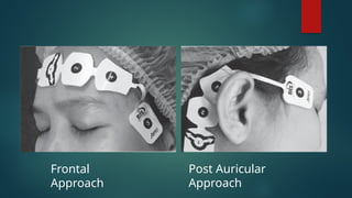 BIS Monitoring and It's Role in Anesthesia - Jeet Dey.pptx