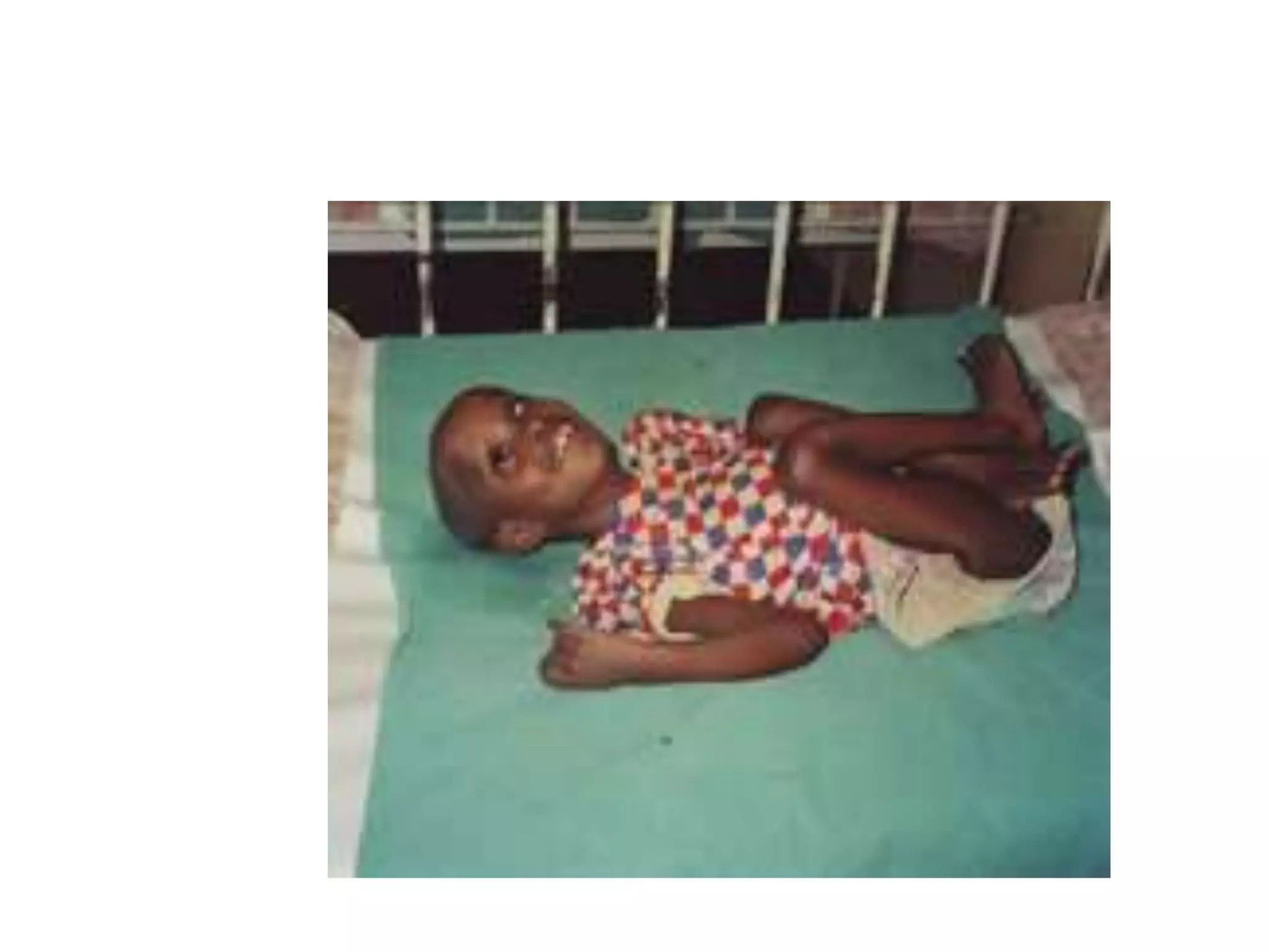 Perinatal Asphyxia | PPTX