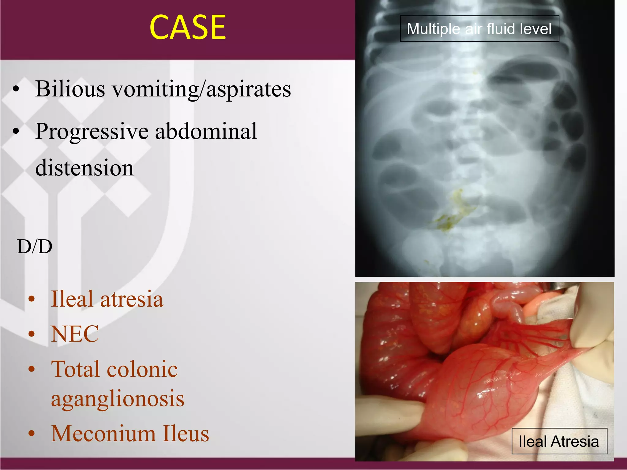 Newborn surgical-emergencies | PDF