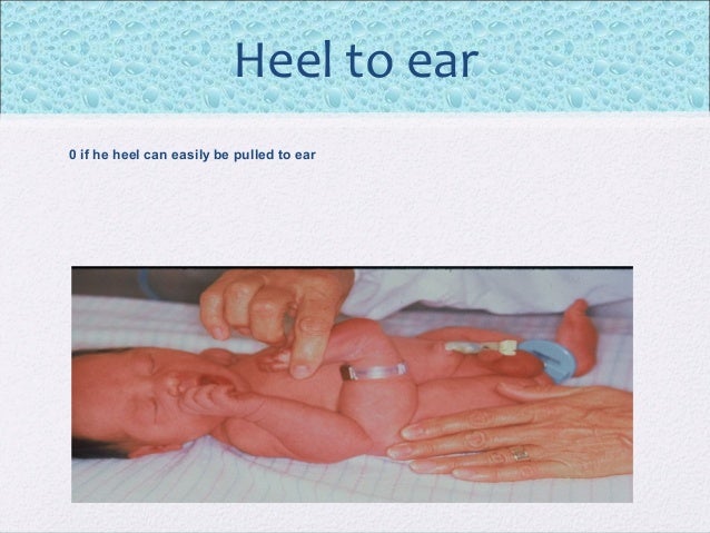 Newborn assessment