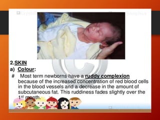 Ruddy Complexion Baby