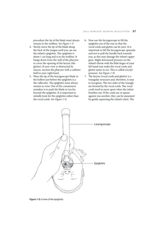 Newborn Care: Skills workshop Neonatal resuscitation | PDF