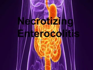 Necrotizing Enterocolitis | PPT