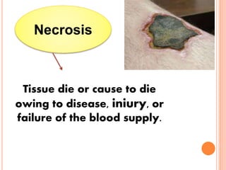 Necrotizing Enterocolitis | PPTX