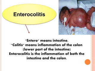 Necrotizing Enterocolitis | PPT