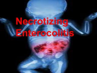 Necrotizing Enterocolitis | PPT