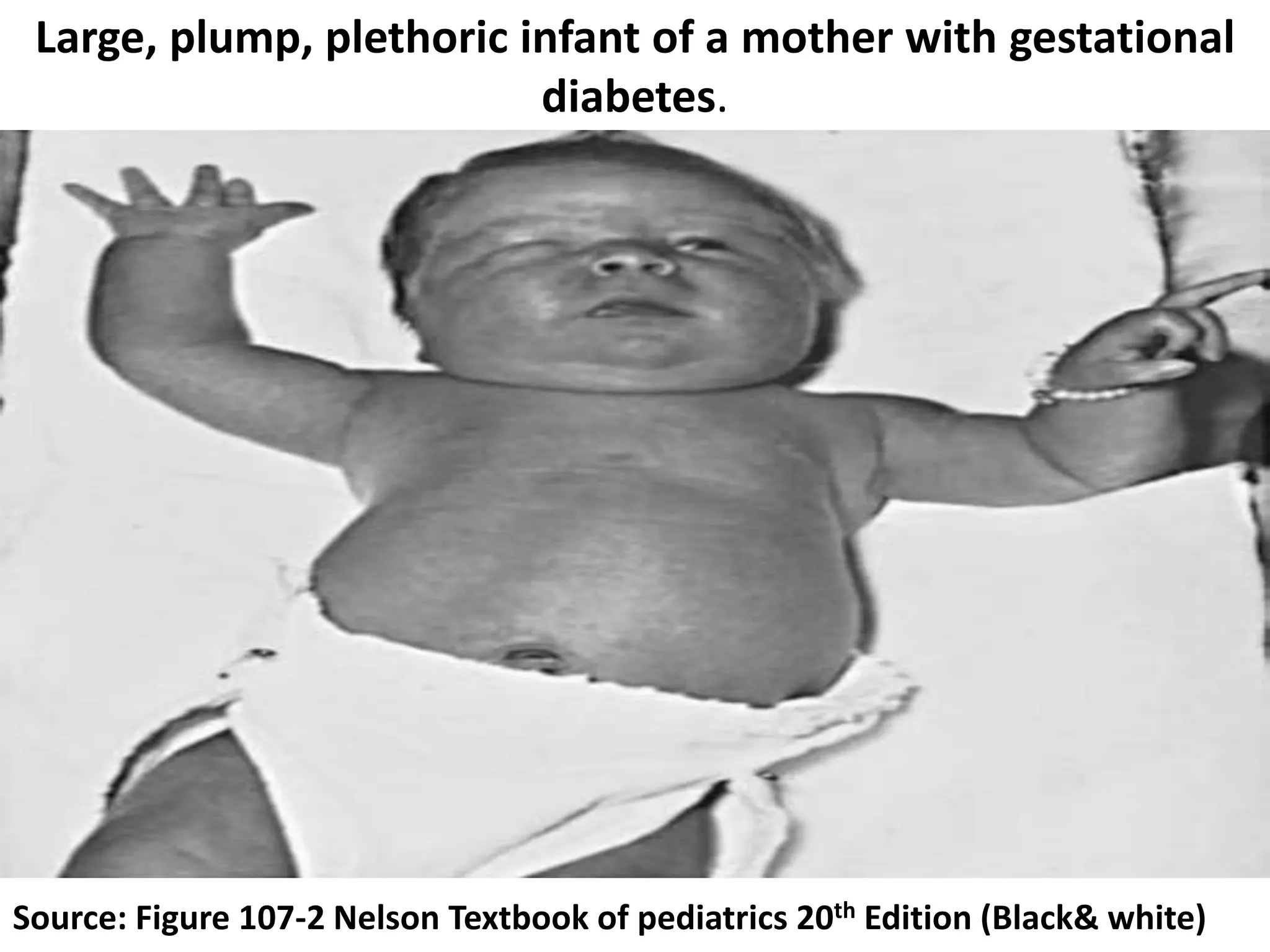 Newborn of a diabetic melitus mother | PPTX