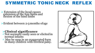 Symmetrical Tonic Neck Reflex