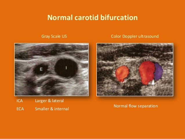 New carotid doppler ultrasound