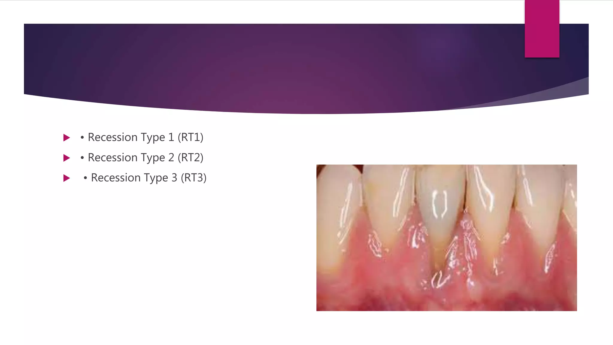 New classification of periodontal disease | PPTX