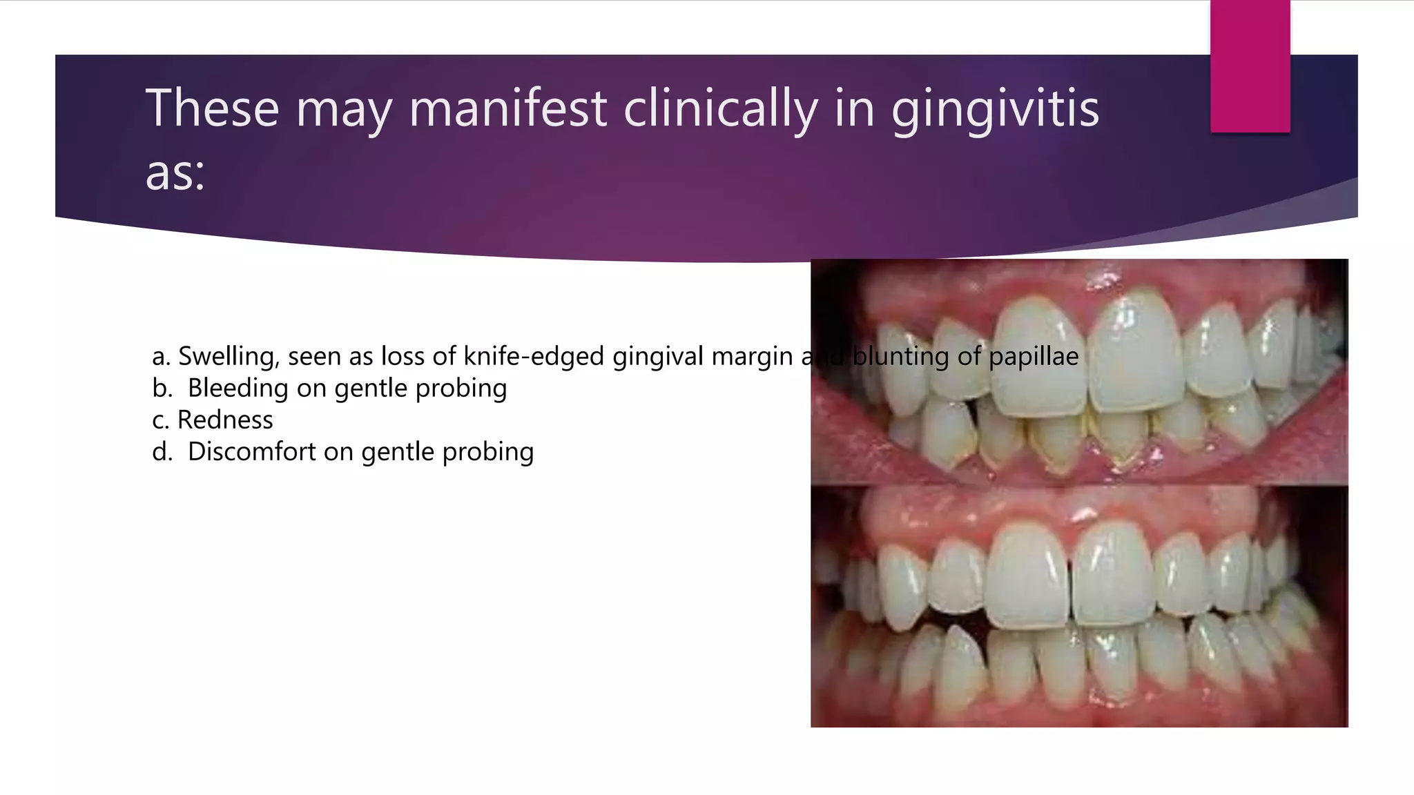 New classification of periodontal disease | PPTX