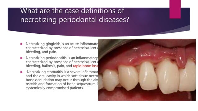 New classification of periodontal disease | PPTX | Dental Health ...