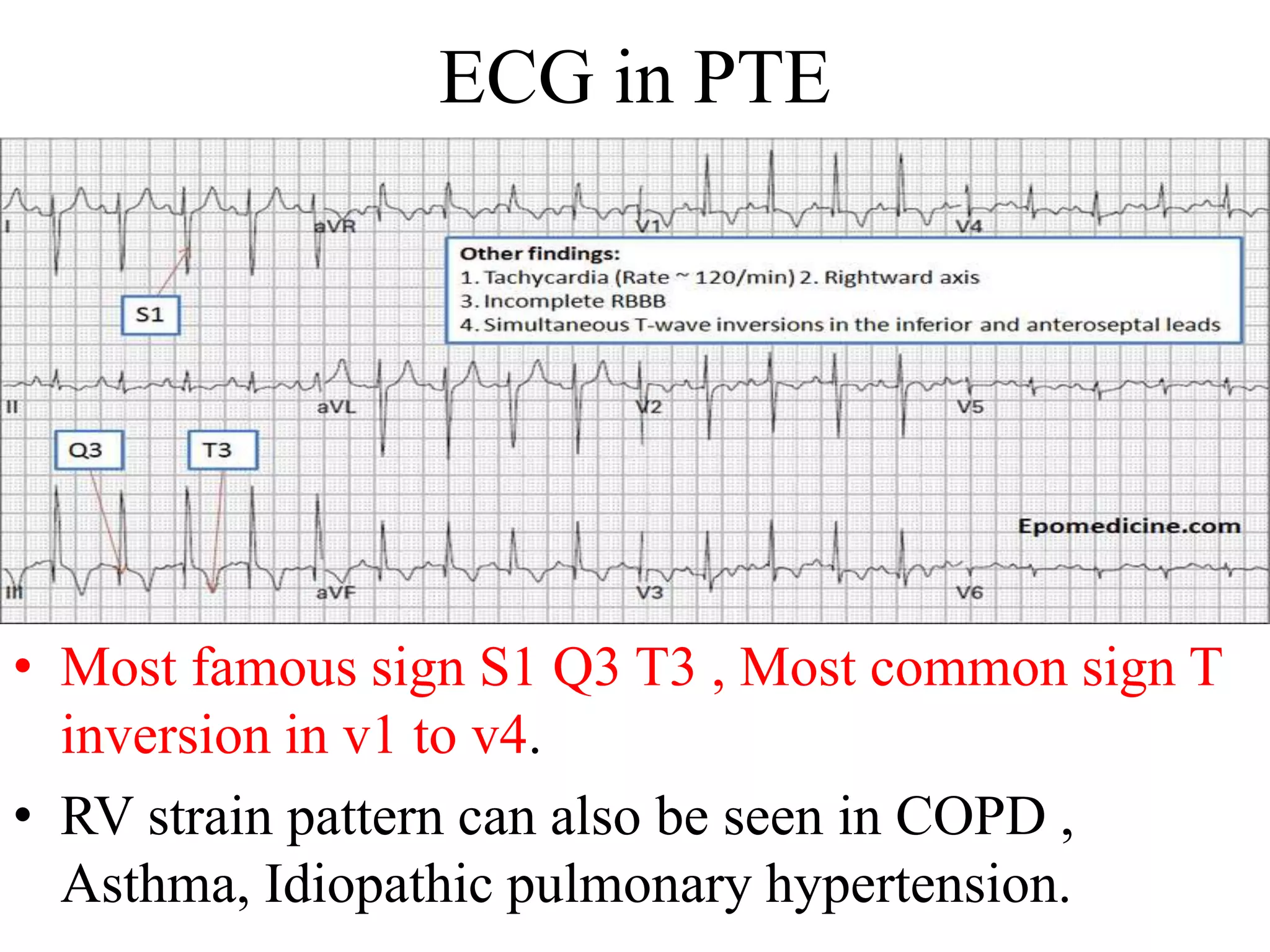 clinical aspects of pulmonary embolism | PPTX
