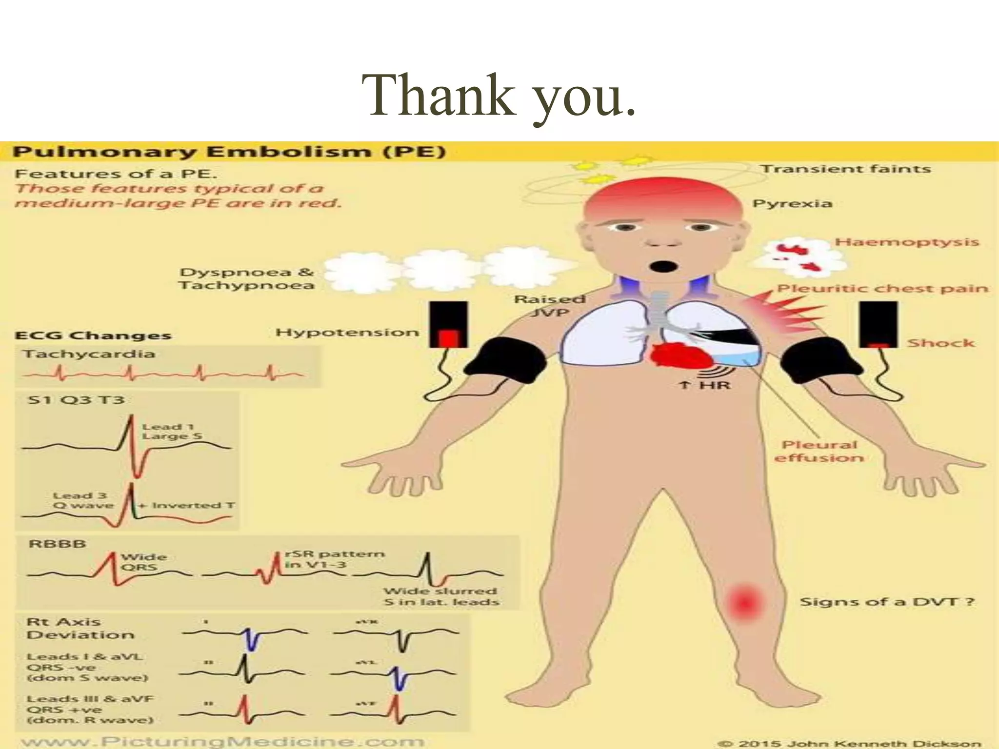 clinical aspects of pulmonary embolism | PPTX