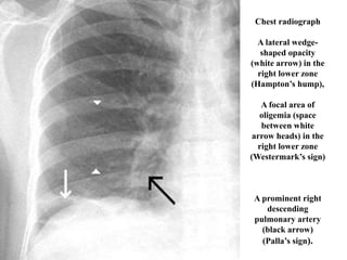 clinical aspects of pulmonary embolism | PPTX