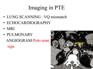 clinical aspects of pulmonary embolism | PPTX