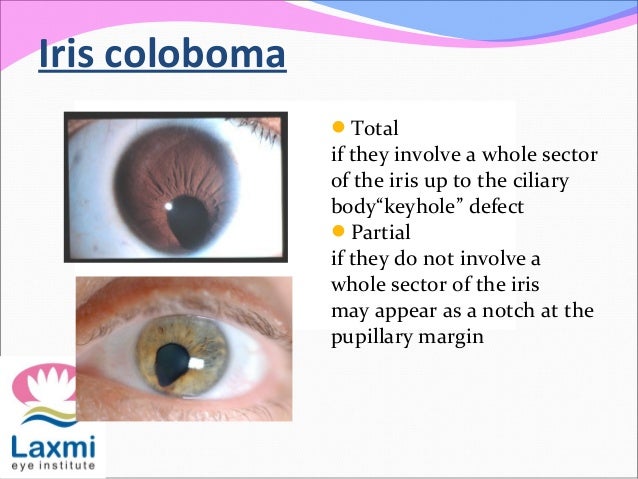 Choroidal coloboma