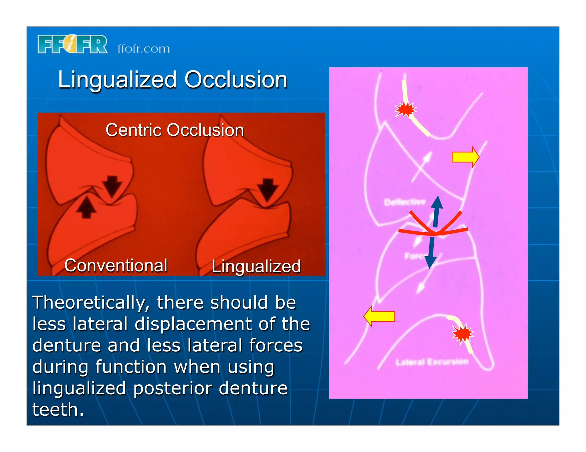 (New) concepts of complete denture occlusion | PDF