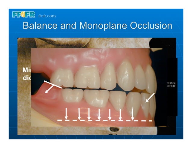 (New) concepts of complete denture occlusion | PDF
