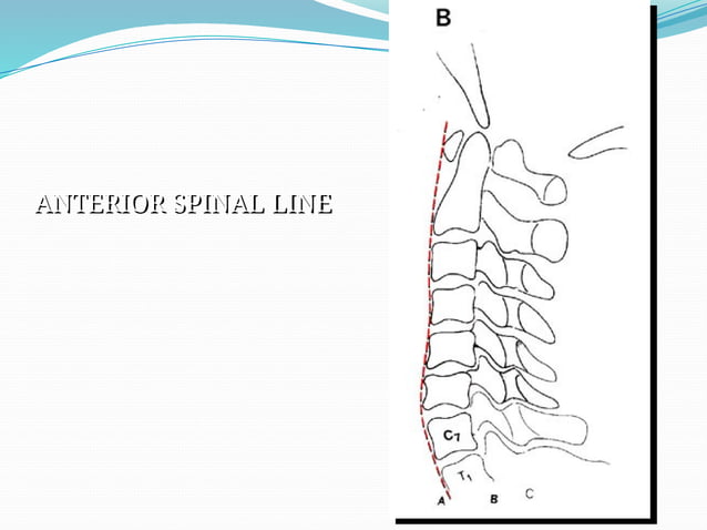 c spine injuries classification management | PPT