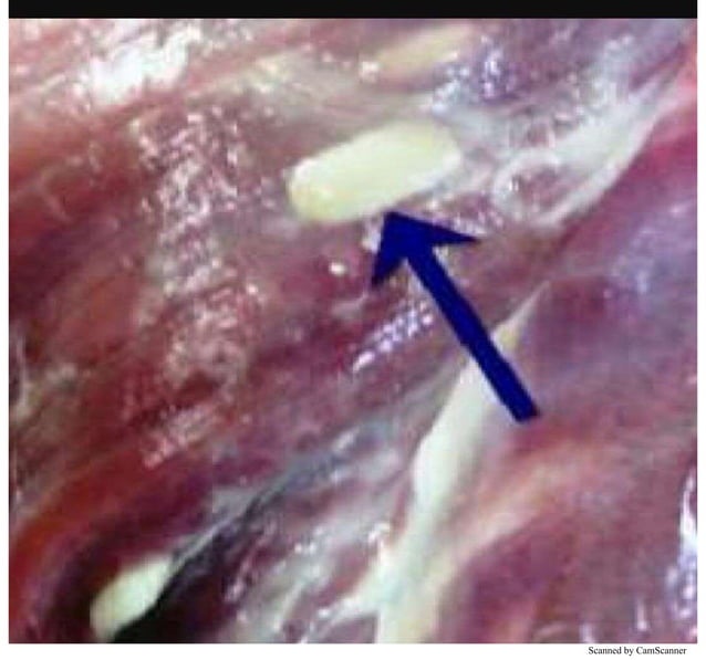 cysticercus tenuicollis&sarcocyst collection photos in sheep | PDF