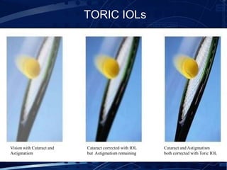 Newer IOLs | PPTX