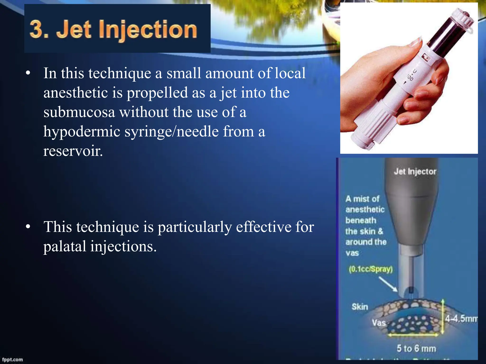 Newer LA Technique recent advances in local Anaesthesia | PPTX