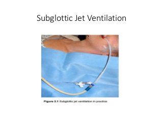 Newer modes of mechanical ventilation | PPTX