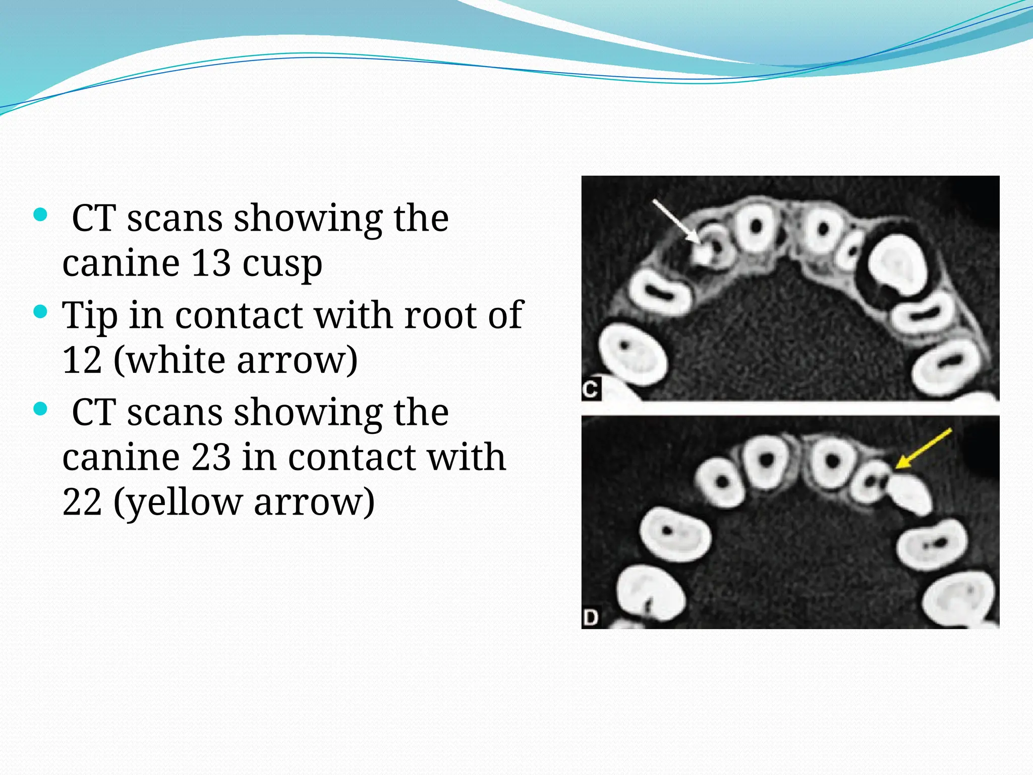 MAXILLARY CANINE impaction techniques.pptx
