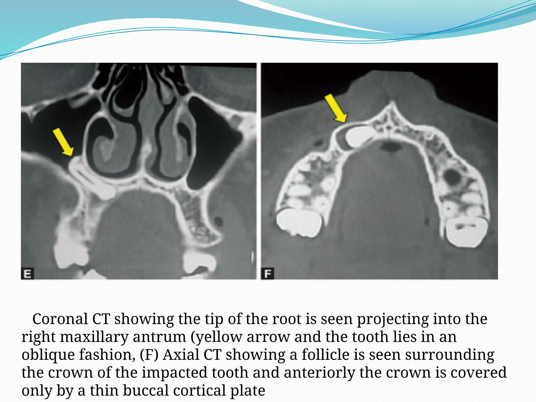 MAXILLARY CANINE impaction techniques.pptx