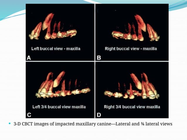 MAXILLARY CANINE impaction techniques.pptx