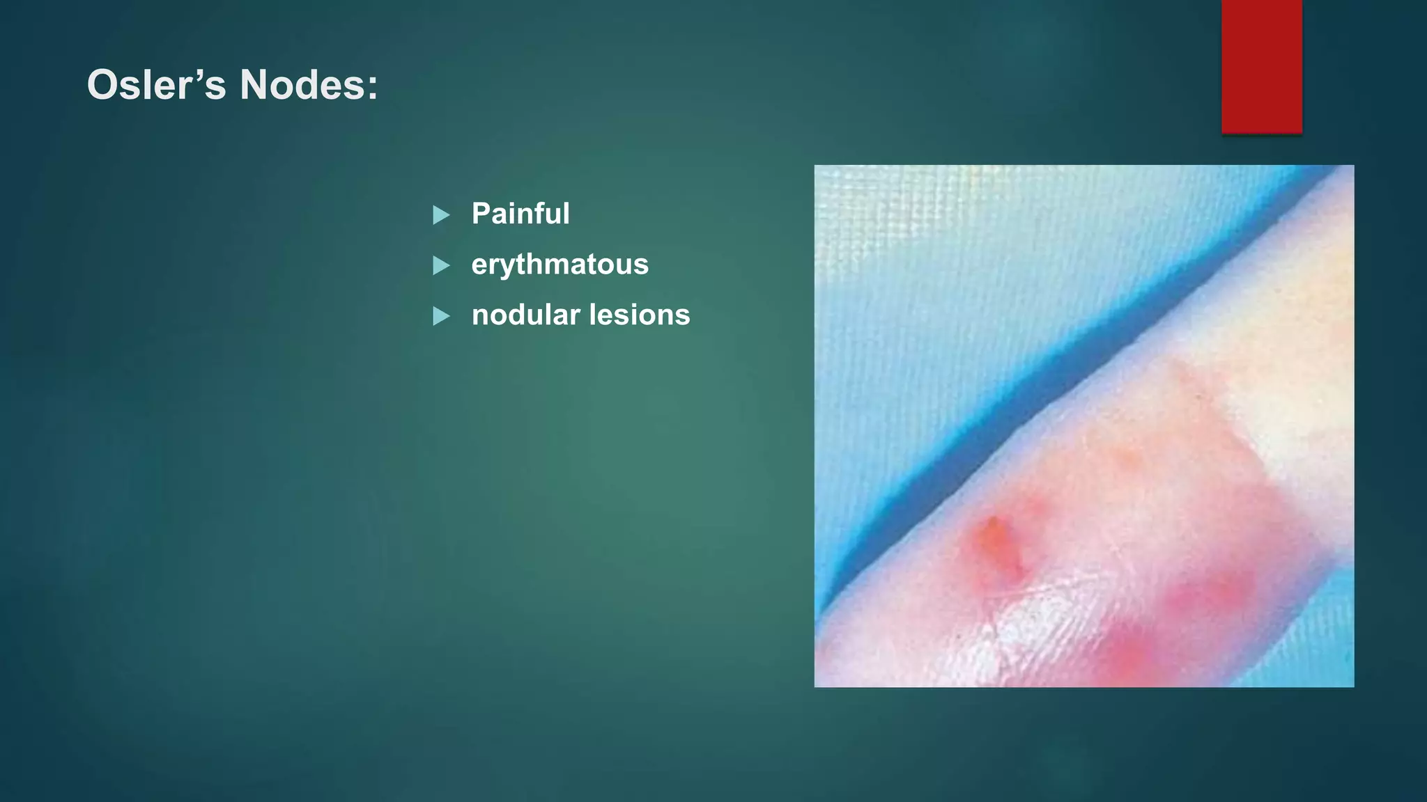 PEDO: New guidelines for prophylaxis against infective endocarditis | PPTX