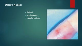 infective endocarditis in children for PEDO 2019 | PPTX