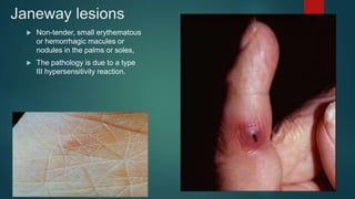 infective endocarditis in children for PEDO 2019 | PPTX