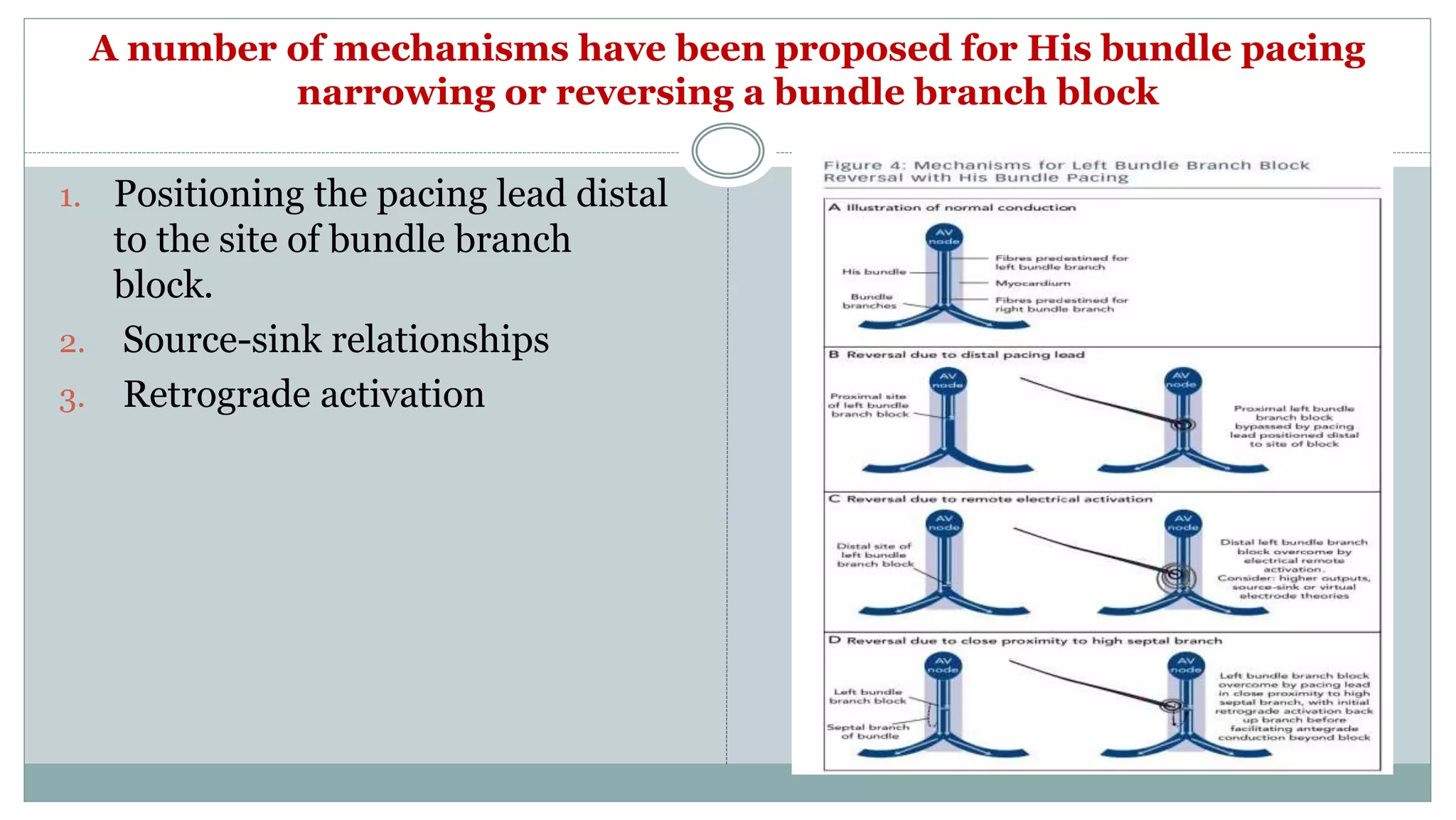 New Heart Failure modalities: HIS Bundle Pacing & Cardiac Contractility ...