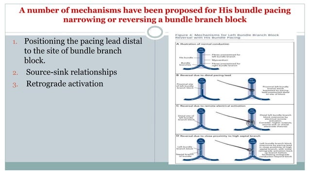 New Heart Failure modalities: HIS Bundle Pacing & Cardiac Contractility ...