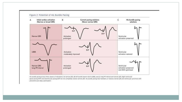 New Heart Failure modalities: HIS Bundle Pacing & Cardiac Contractility ...