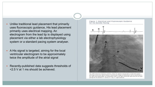 New Heart Failure modalities: HIS Bundle Pacing & Cardiac Contractility ...