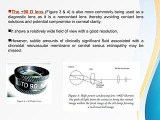 laser lenses for retinal diseases | PPT