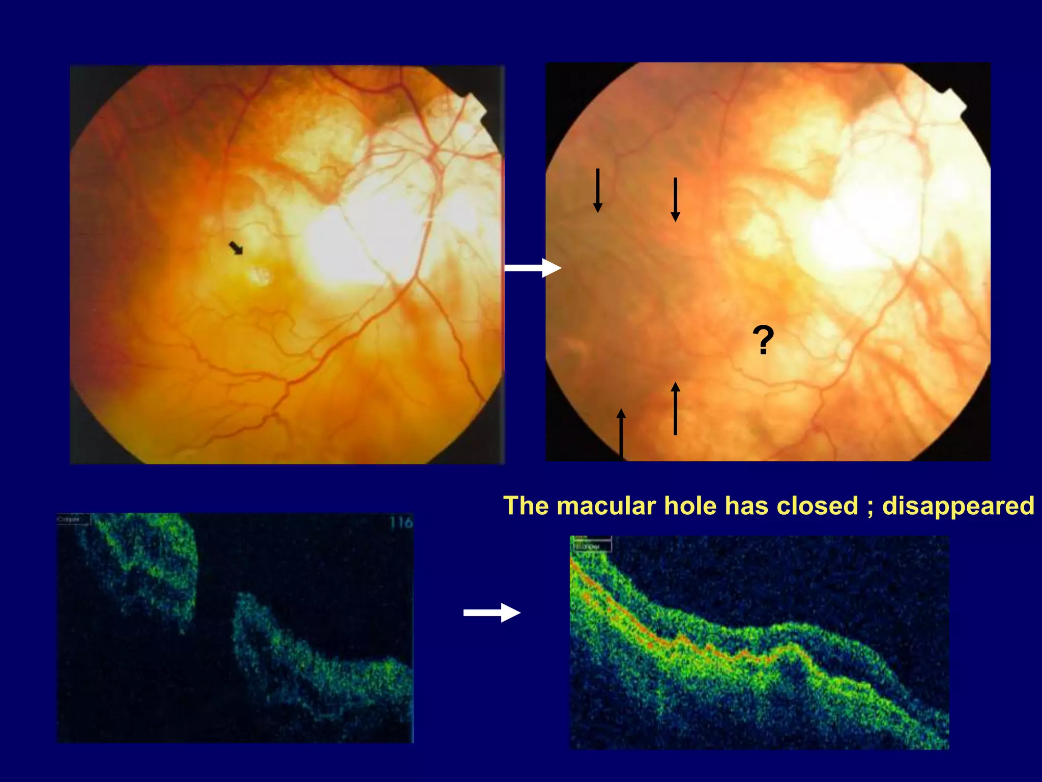 THE MANAGEMENT OF MYOPIC MACULAR HOLE RETINAL DETACHMENT | PPT