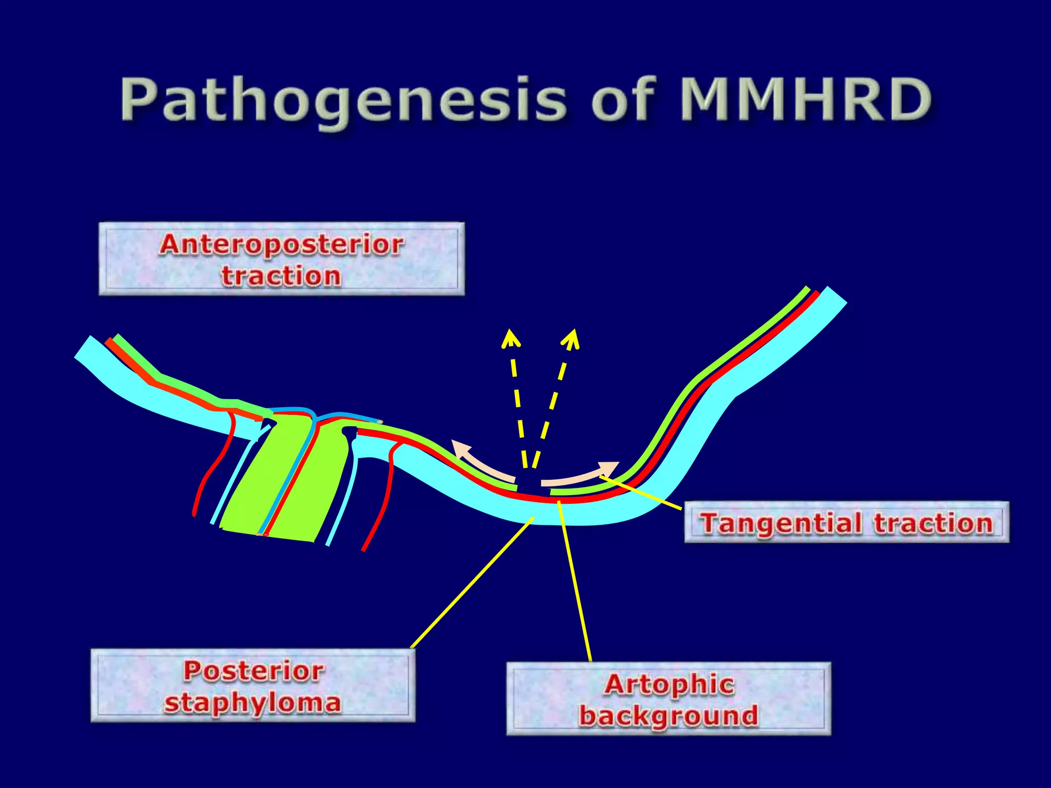 THE MANAGEMENT OF MYOPIC MACULAR HOLE RETINAL DETACHMENT | PPT