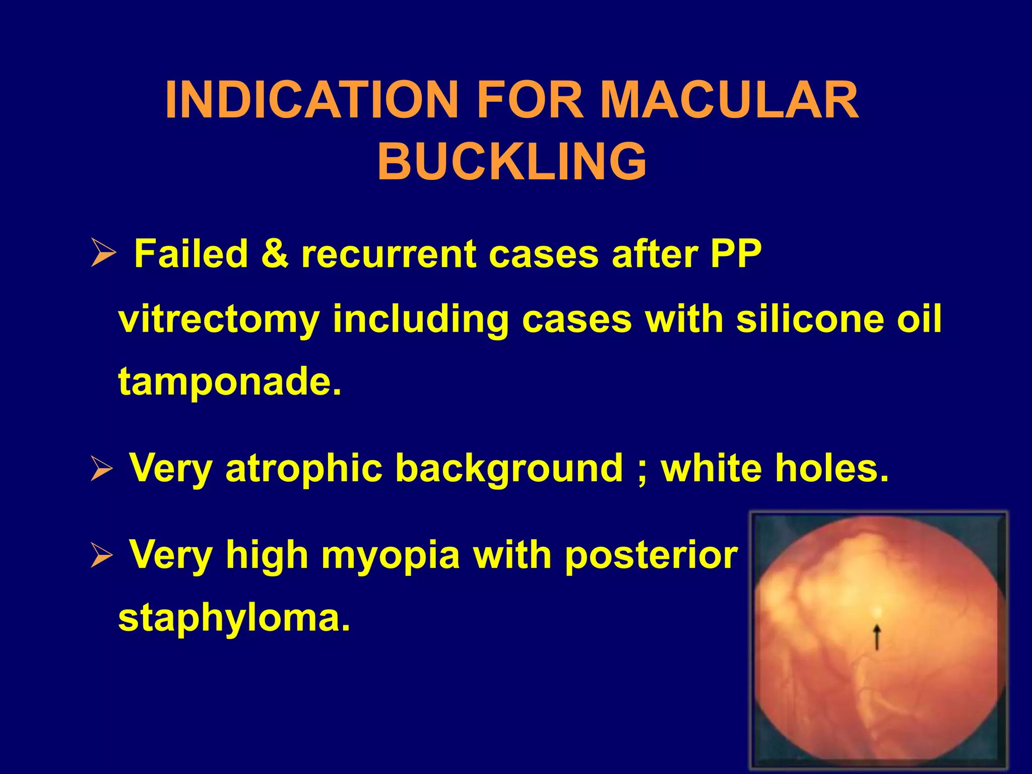 THE MANAGEMENT OF MYOPIC MACULAR HOLE RETINAL DETACHMENT | PPT