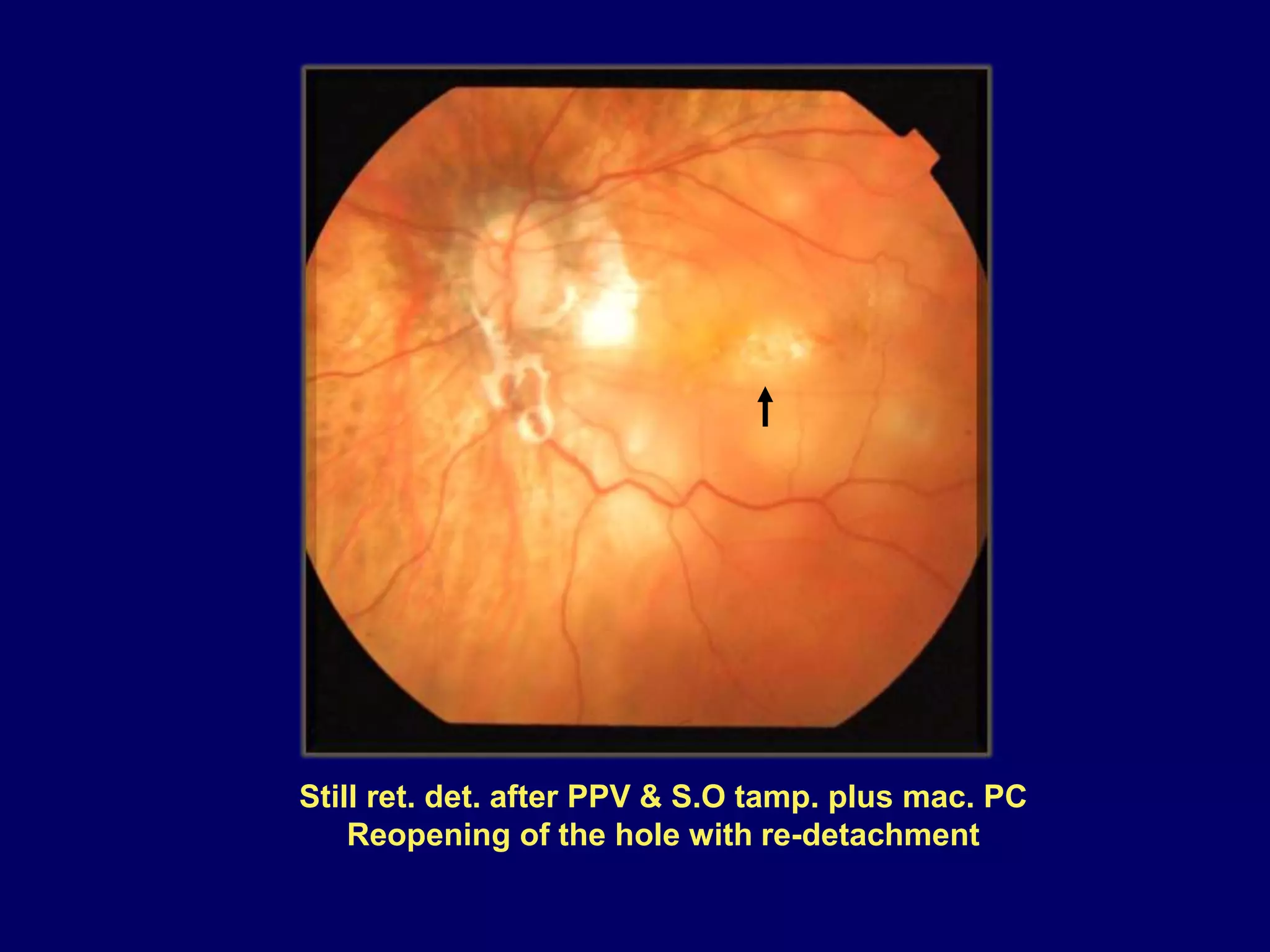 THE MANAGEMENT OF MYOPIC MACULAR HOLE RETINAL DETACHMENT | PPT