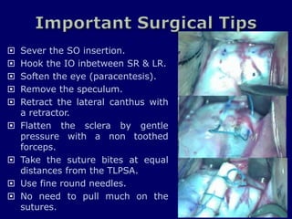 THE MANAGEMENT OF MYOPIC MACULAR HOLE RETINAL DETACHMENT | PPT