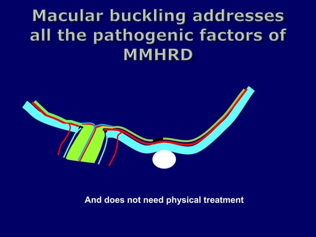 THE MANAGEMENT OF MYOPIC MACULAR HOLE RETINAL DETACHMENT | PPT